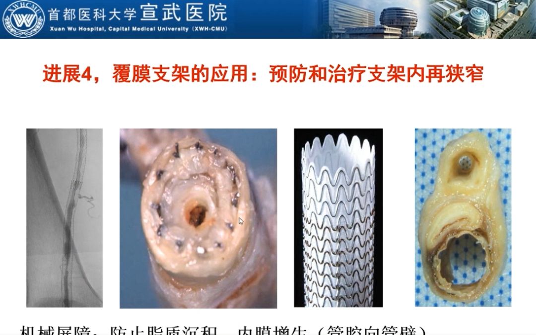 从我国下肢动脉硬化闭塞症血管介入治疗的进展看未来介入产品的...
