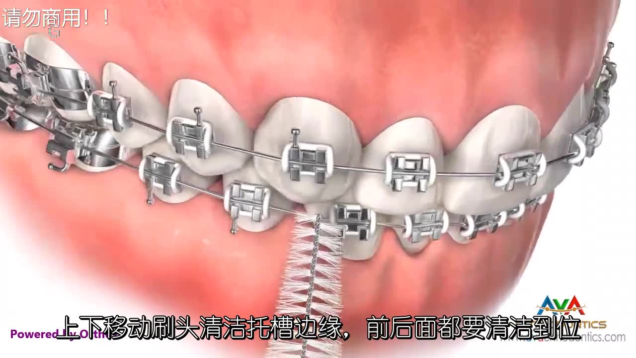 【中字】干货!up主教你如何戴牙套期间使用间隙刷和牙线!