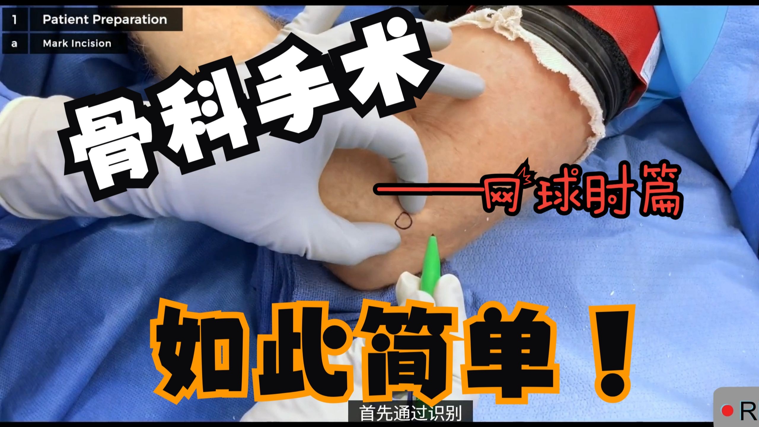 【4K骨科手术视频教学】网球肘(肱骨外上髁炎症)能手术吗?全程实录...