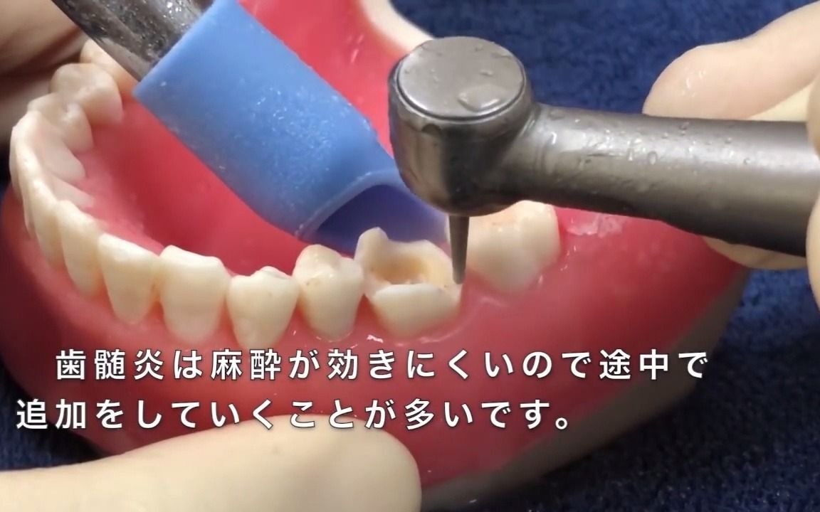 【根管治疗】根管治疗的全过程!清晰完整的看你的牙齿是怎么被掏空的