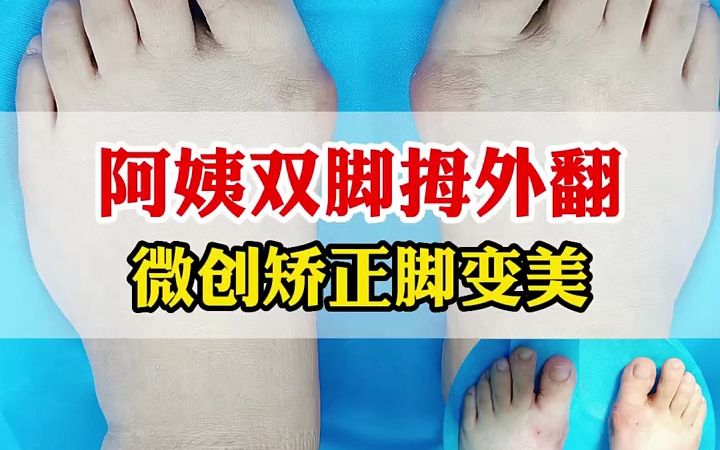 阿姨双脚拇外翻,微创矫正脚变美