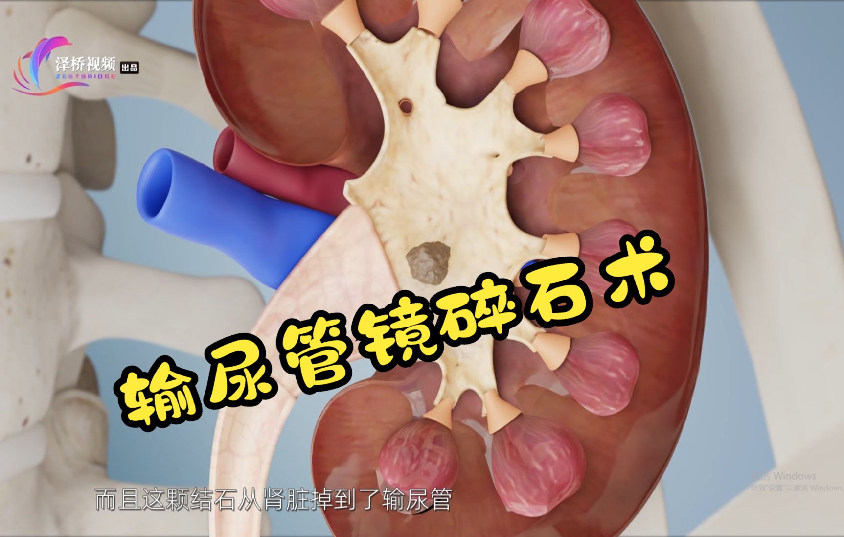 【3D视频】输尿管镜碎石手术