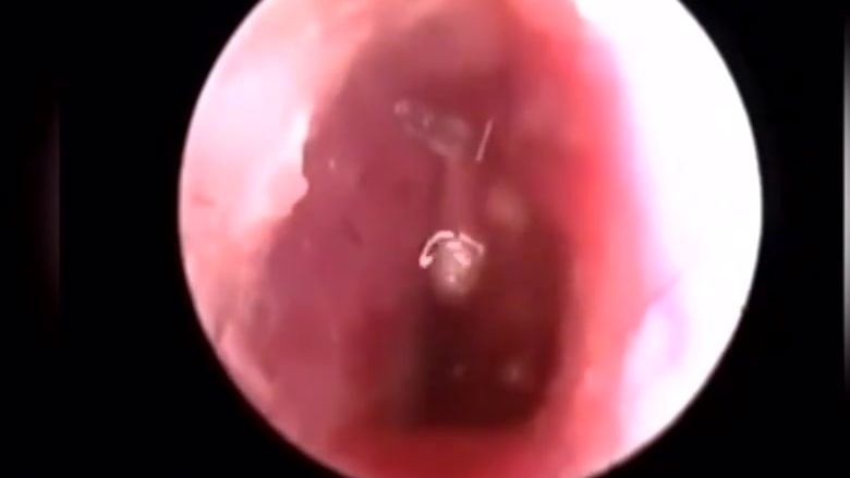 女子耳朵流脓 医生吓一跳 耳内竟有12条肥肥的蛆虫