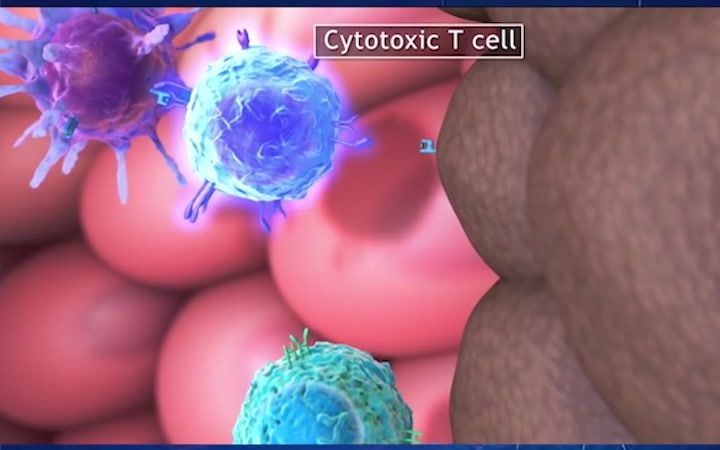 卡介苗(BCG)膀胱内用灌注剂(Immunobladder intravesical)是膀胱癌...