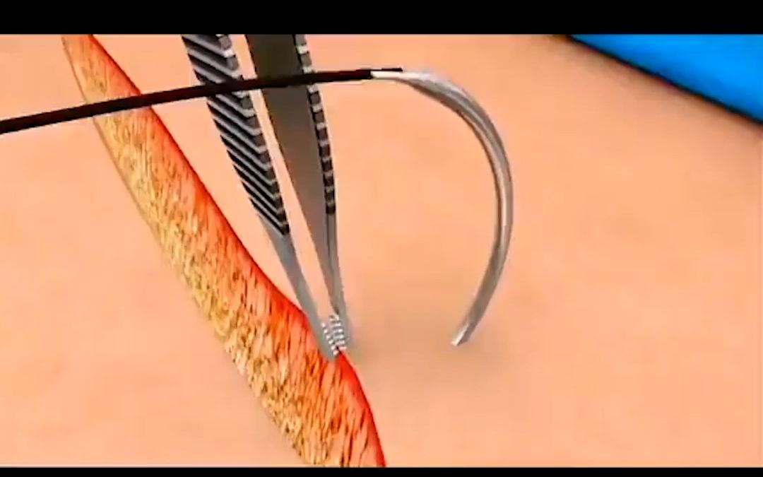 外科医生的针不是“直的”,最基本的缝合技术,看懂你就能当外科医生了