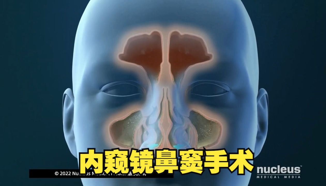 【3D医学动画】内窥镜鼻窦手术