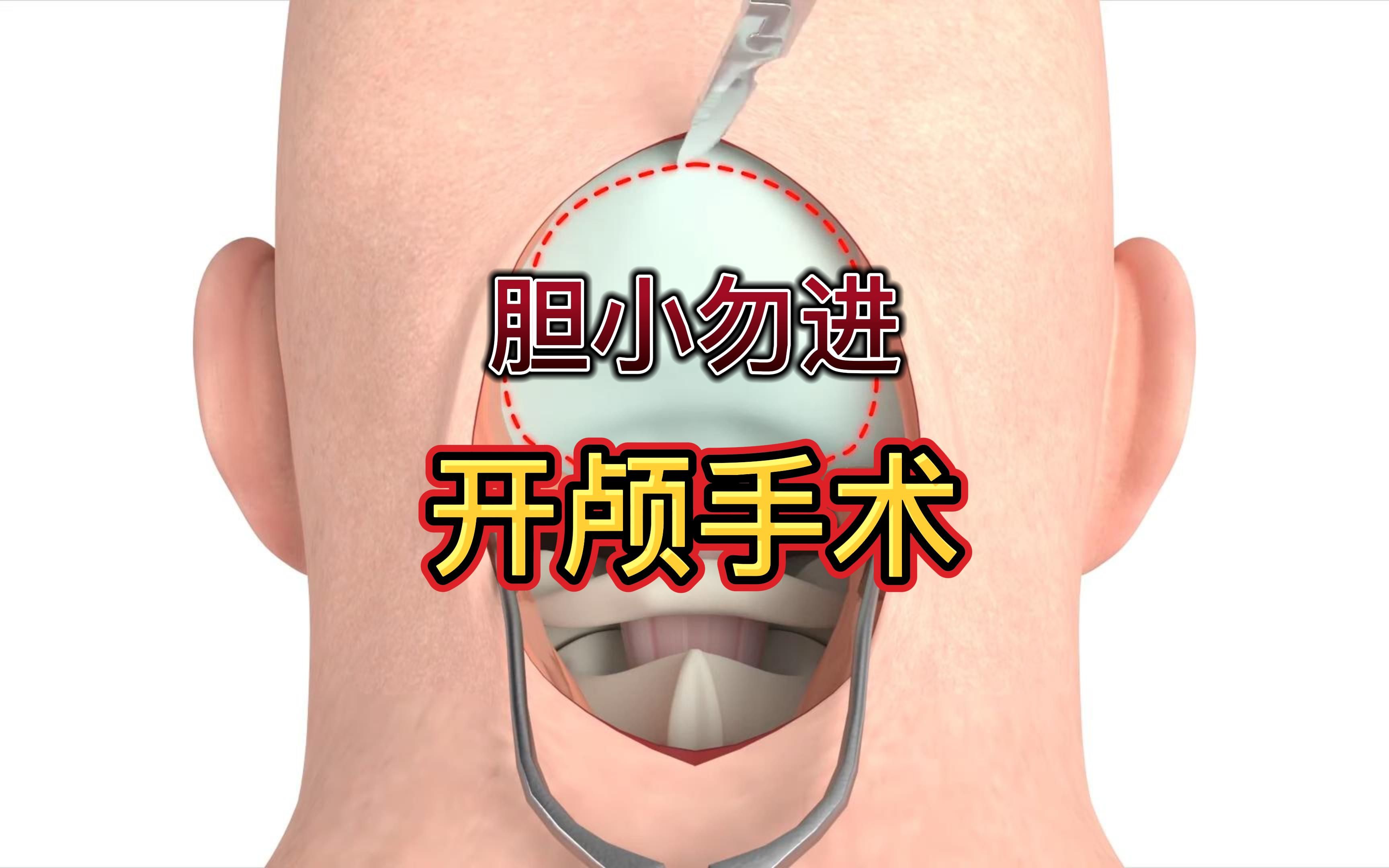 胆小勿进|开颅手术挑战|3D动画