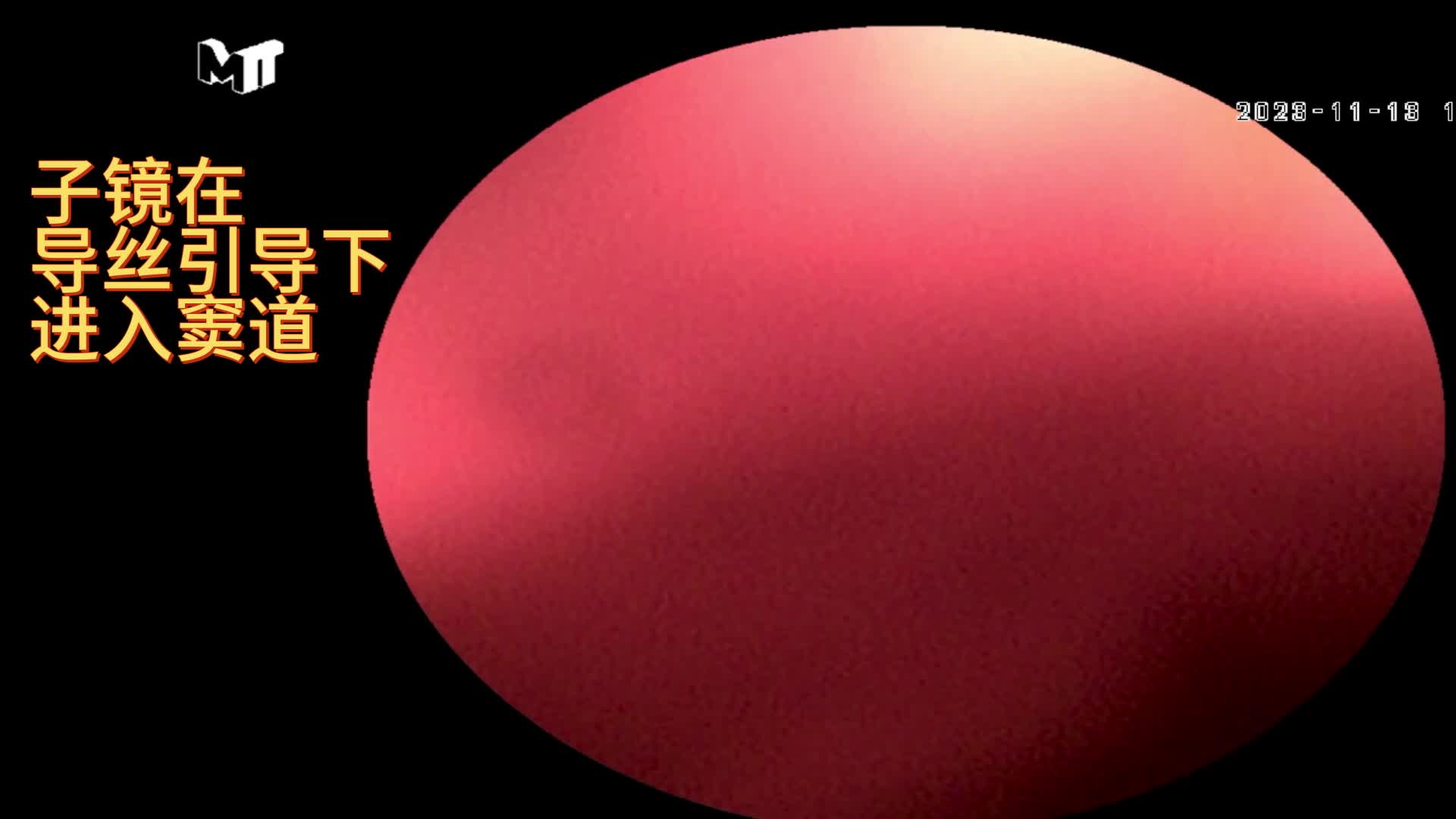 胆道子镜妙用--ERCP失败后梗阻性黄疸减黄成功