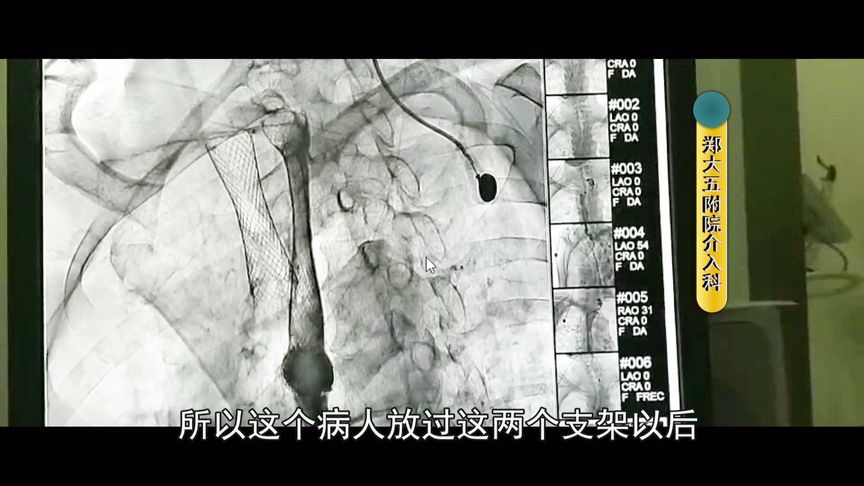62岁食管癌术后复发,食管气管瘘,医生双支架解决无法进食大问题