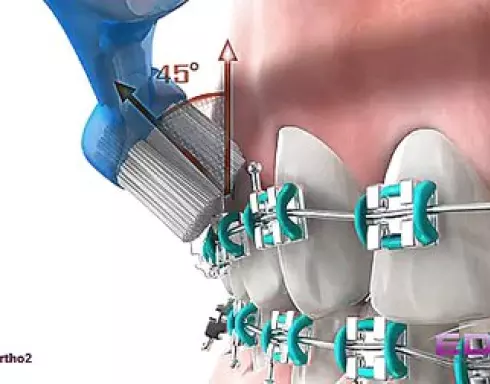 带牙套时正确的刷牙 动画演示_标清