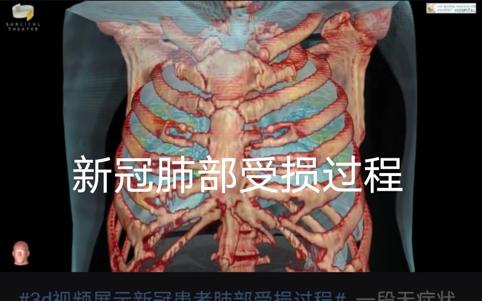 新冠病毒给肺部造成的伤害有多严重