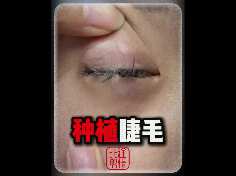 吓疯!18岁少女种植 “狐狸眼睫毛” 变独眼,眼皮里爬满螨虫,角膜烂到...