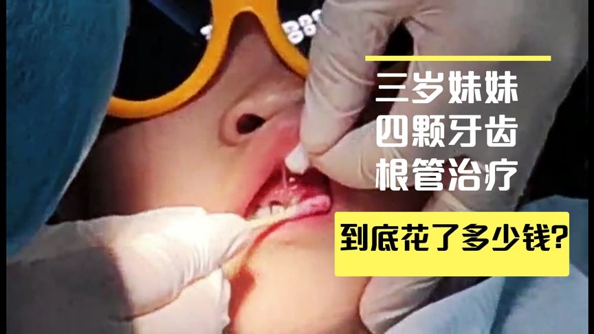 都说看牙贵,看看妹妹四颗牙齿根管治疗花了多少钱?宝妈很满意