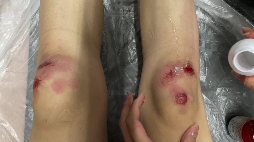 沉浸式处理伤口 双氧水+碘伏yyds#有一种疼叫做看着都疼