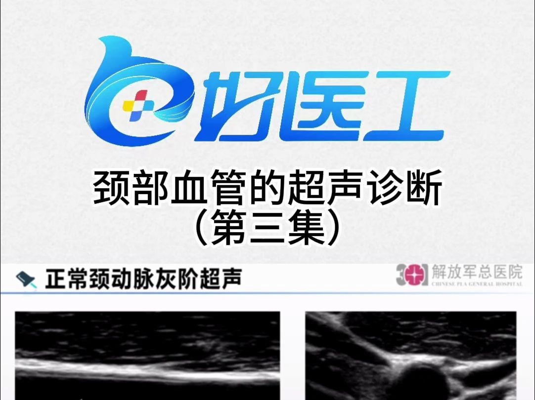 颈部血管的超声诊断(第三集)