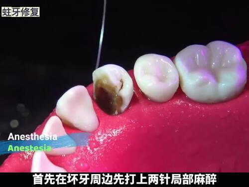 烂牙逆袭重生术:一图看懂根管治疗的 "魔鬼细节" 爱护牙齿牙齿蛀牙...
