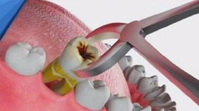 智齿是如何生长的呢?3D动画模拟全过程!看完真想拔掉!