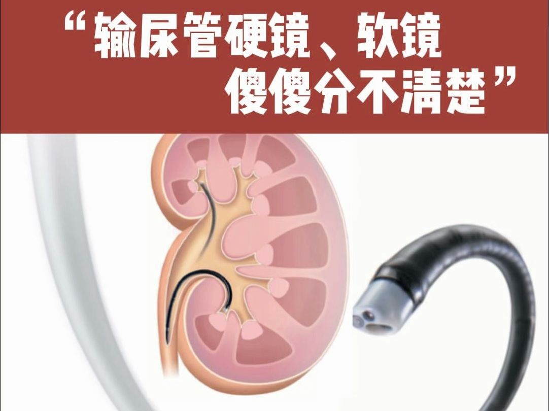 输尿管硬镜、软镜,傻傻分不清楚
