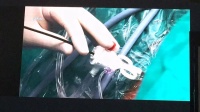 深圳康医博带吸附清石及测压装置的输尿管软镜导引鞘-广州医科大学...