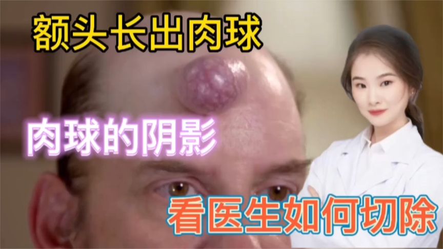 医学实录 额头上长出肉球状的肿瘤 看医生如何切除