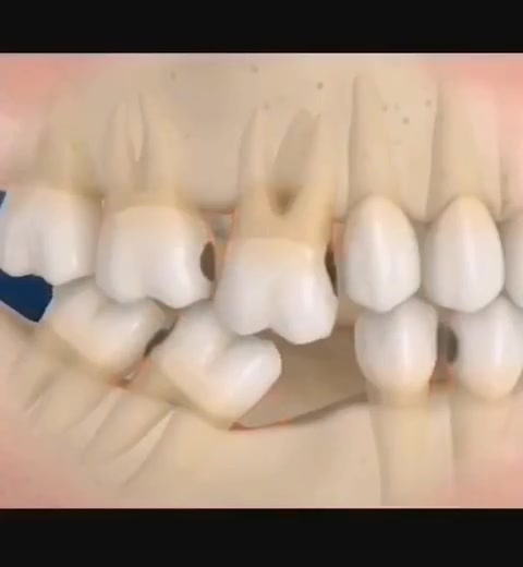 单颗牙齿缺失的后果