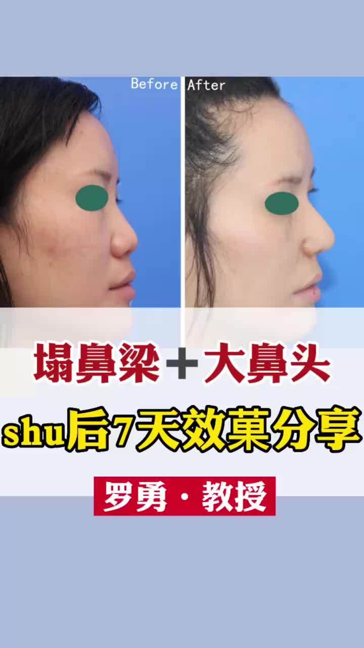 塌鼻梁且大鼻头改善,鼻综合术后7天效果!
