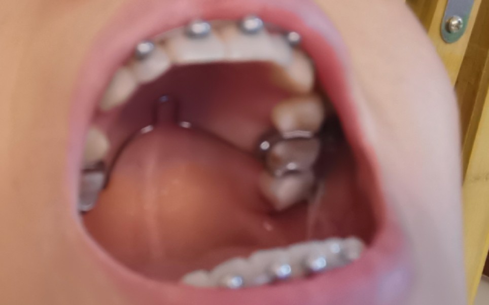 骨性前突牙齿正畸六个月,拔牙四颗,粘舌侧钉两颗,戴上颌扩弓器,打两颗...