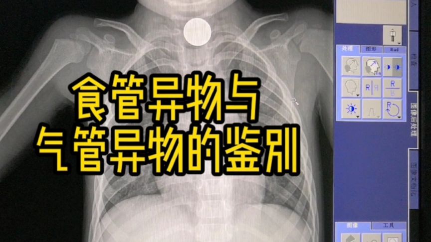 食管异物与气管异物的鉴别