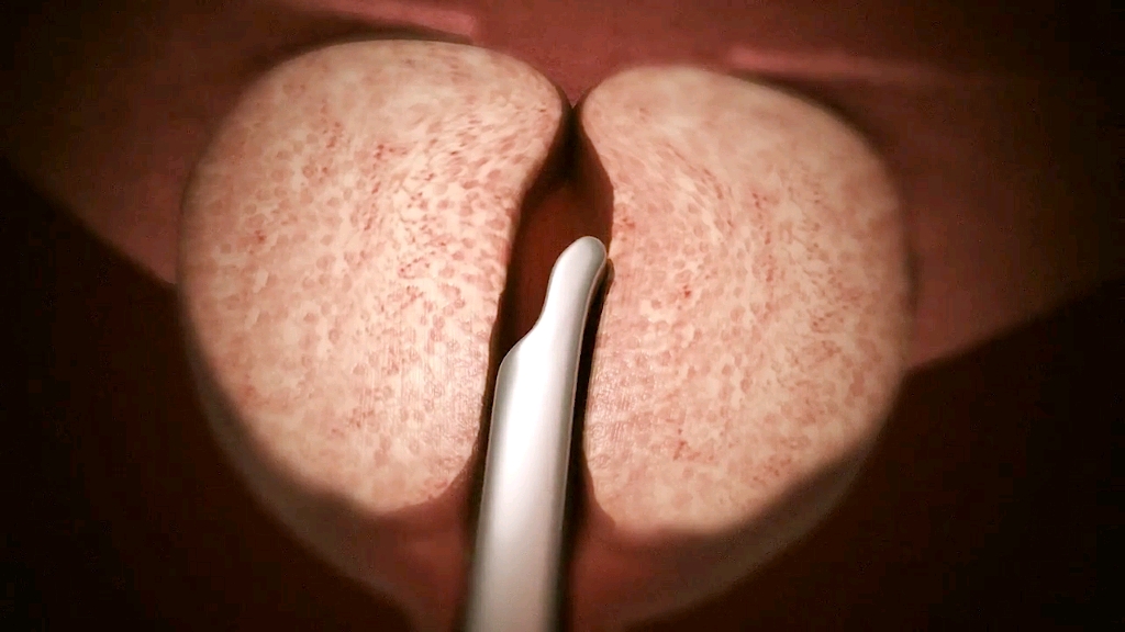 15分钟前列腺微创手术操作讲解