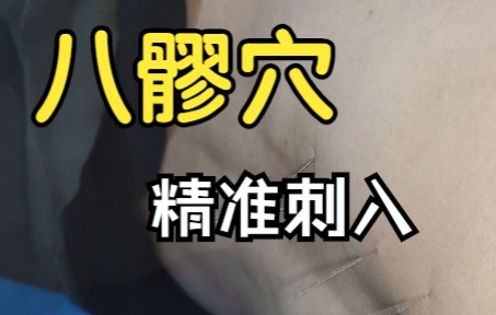 八髎穴刺法 | 孔向各不相同,因人而异