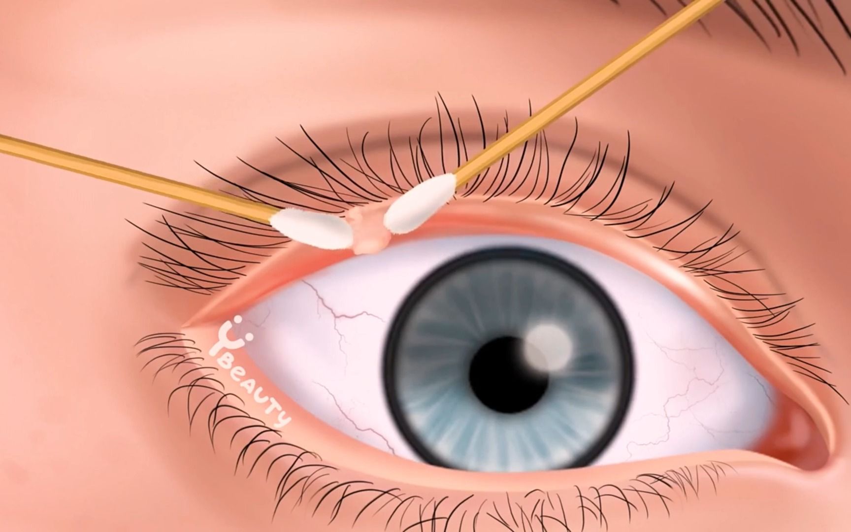 给美女挤痘痘,清完超级爽!#解压动画