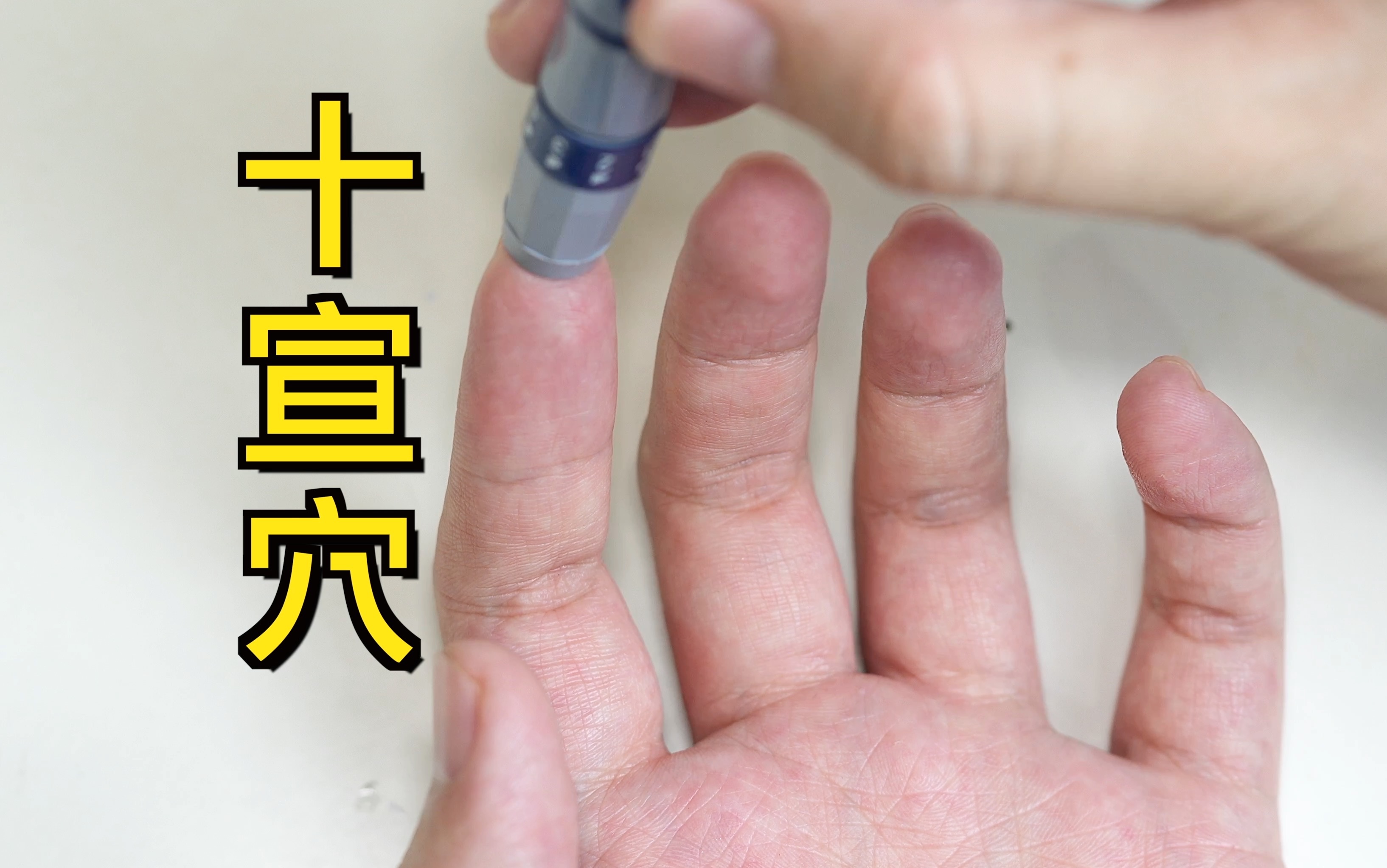 十宣穴,刺血疗法。急救,昏迷,癫痫,高热,惊厥。