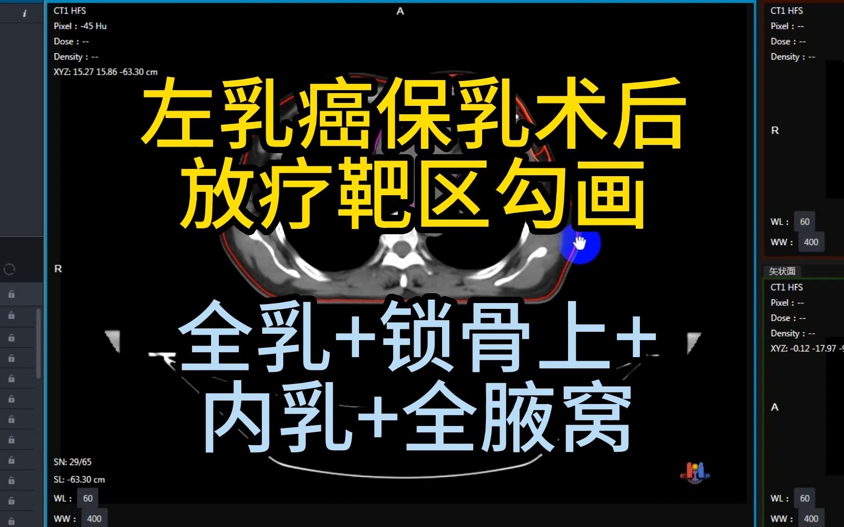 左侧乳腺癌保乳术后放疗策略和靶区勾画原则