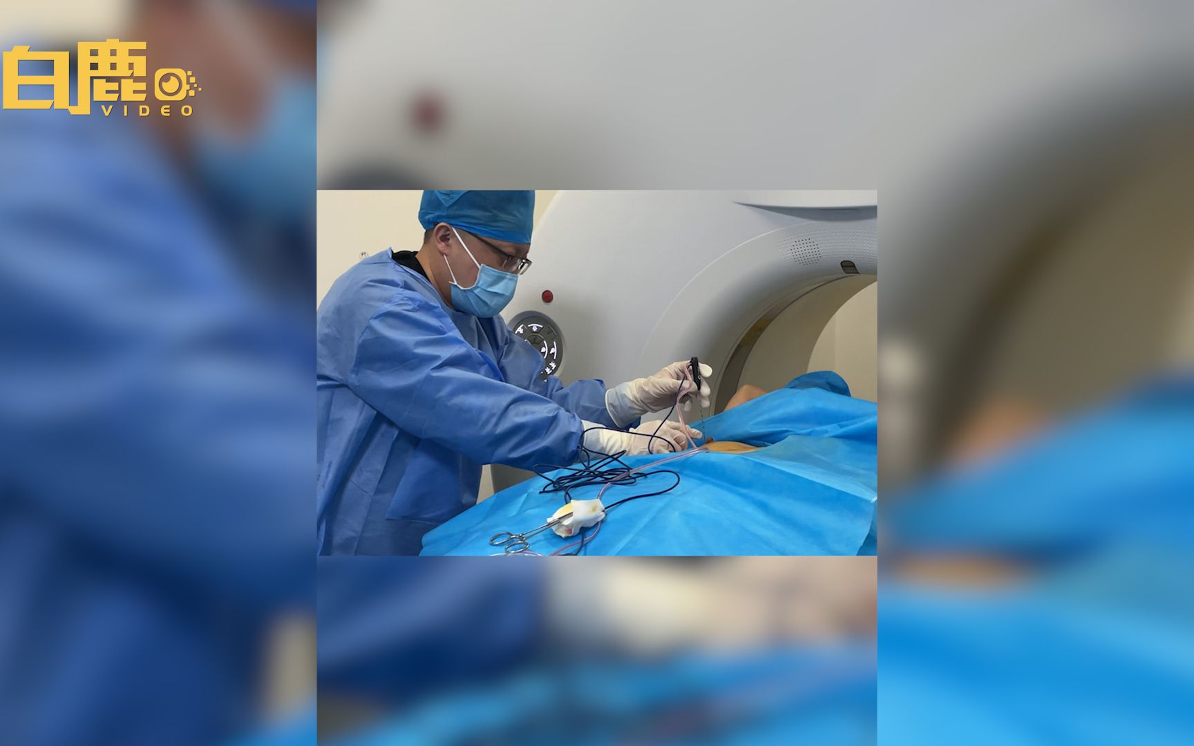 医生30分钟一针穿刺烧毁2处癌细胞, 用3d打印模板精准定位穿刺点