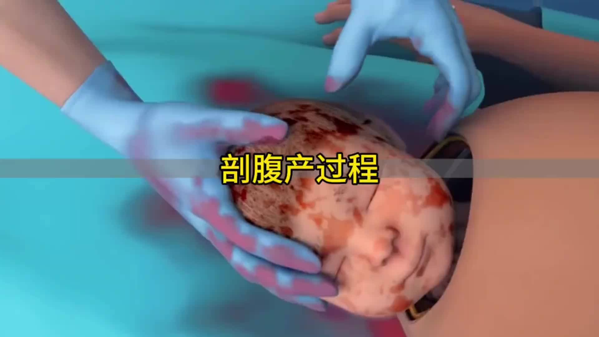 剖腹产术过程,一定要好好爱自己的妈妈!