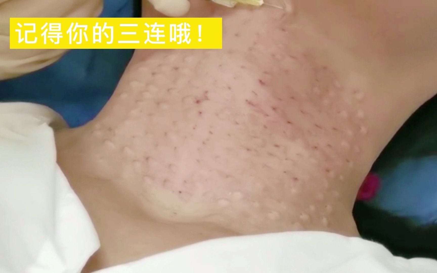 ...纹注射Vlog | 密集恐惧者慎入!水光针注射颈纹,个性化定制去除颈纹方案