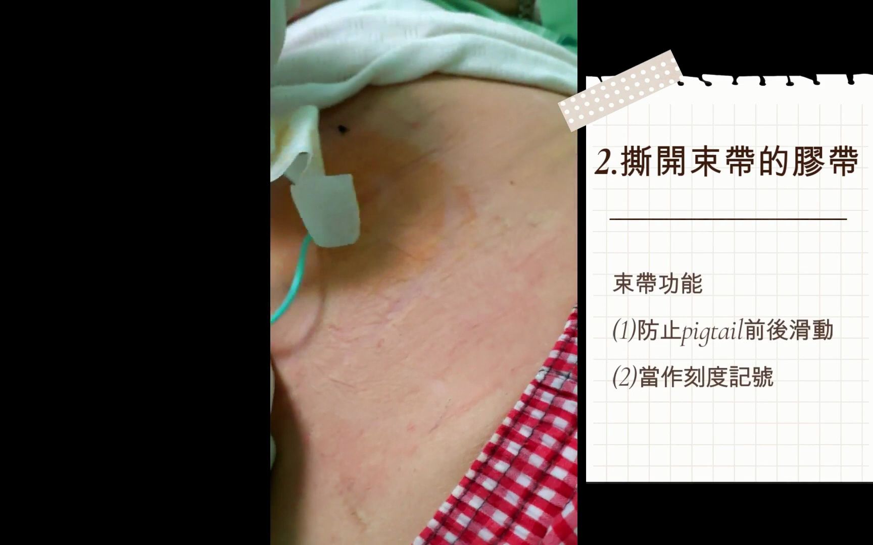 ...catheter 如何移除豬尾巴引流管?步驟、護理備物(PTCD, PTGBD, liv
