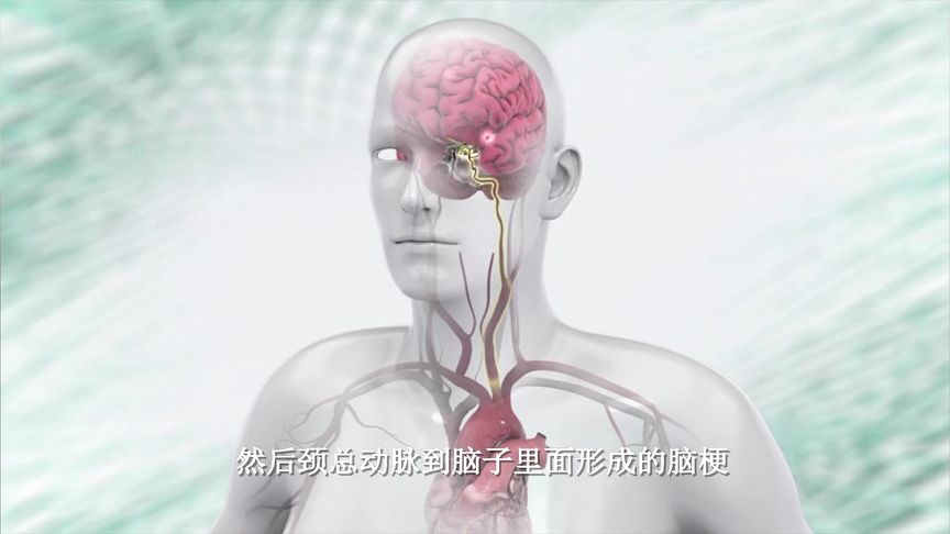 一种少见的脑梗——卵圆孔未闭。动画的形式带你了解