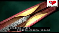 原来冠脉支架这样放!
