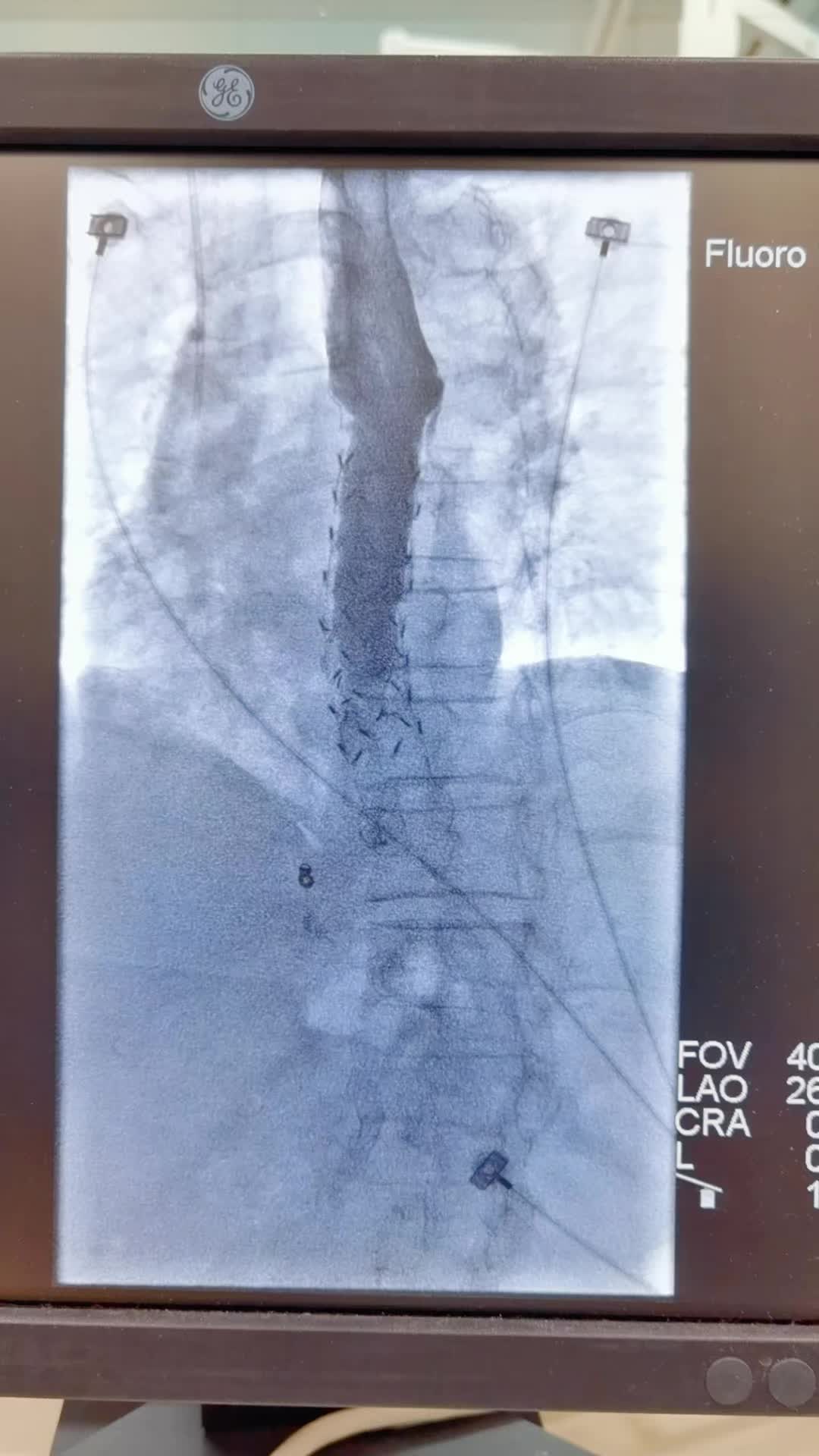 食管纵隔胸膜瘘覆膜支架封堵加脓腔引流管置入