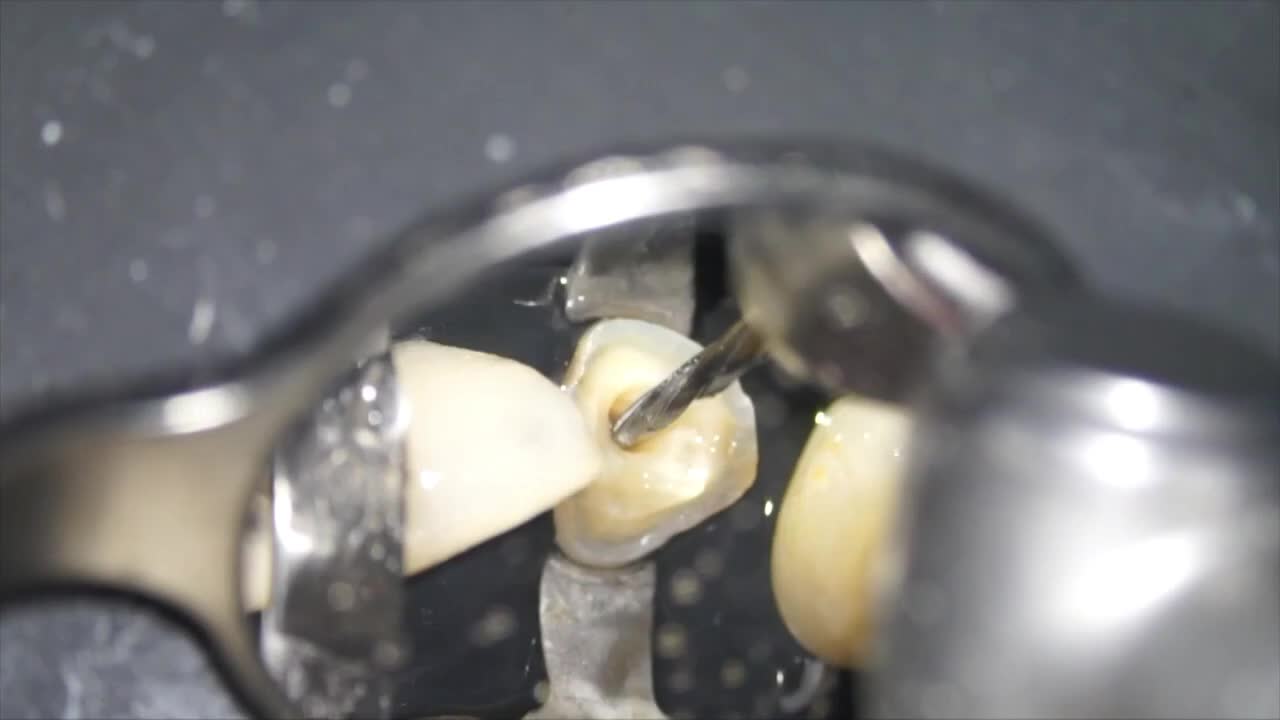 打桩堆塑树脂核取模全程#根管治疗 #桩核冠 #旭弟 #口腔助理医师...