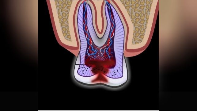 口腔修复系列教学视频——桩冠3