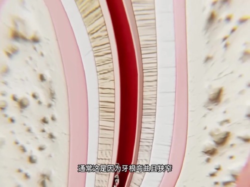 发明根管治疗的真是个天才,其实钢针断在牙齿里面也没有关系的