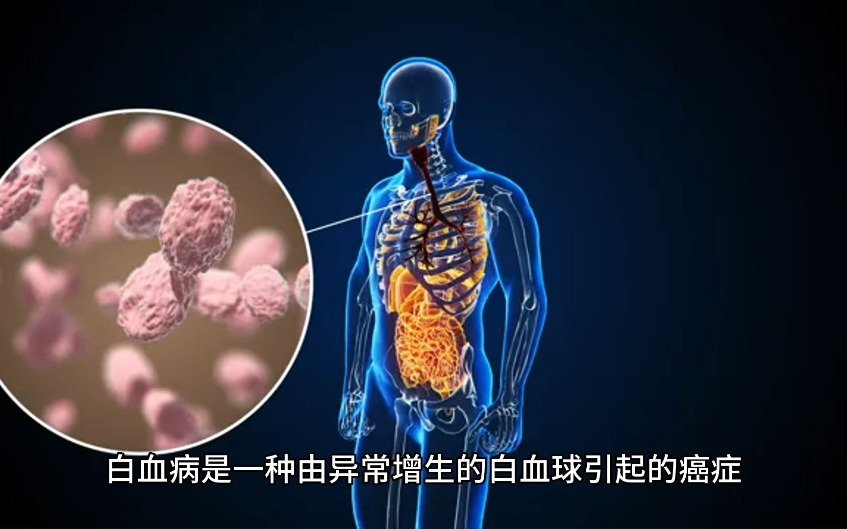 一分钟带你了解白血病是如何产生的,真不希望有人得这种病!