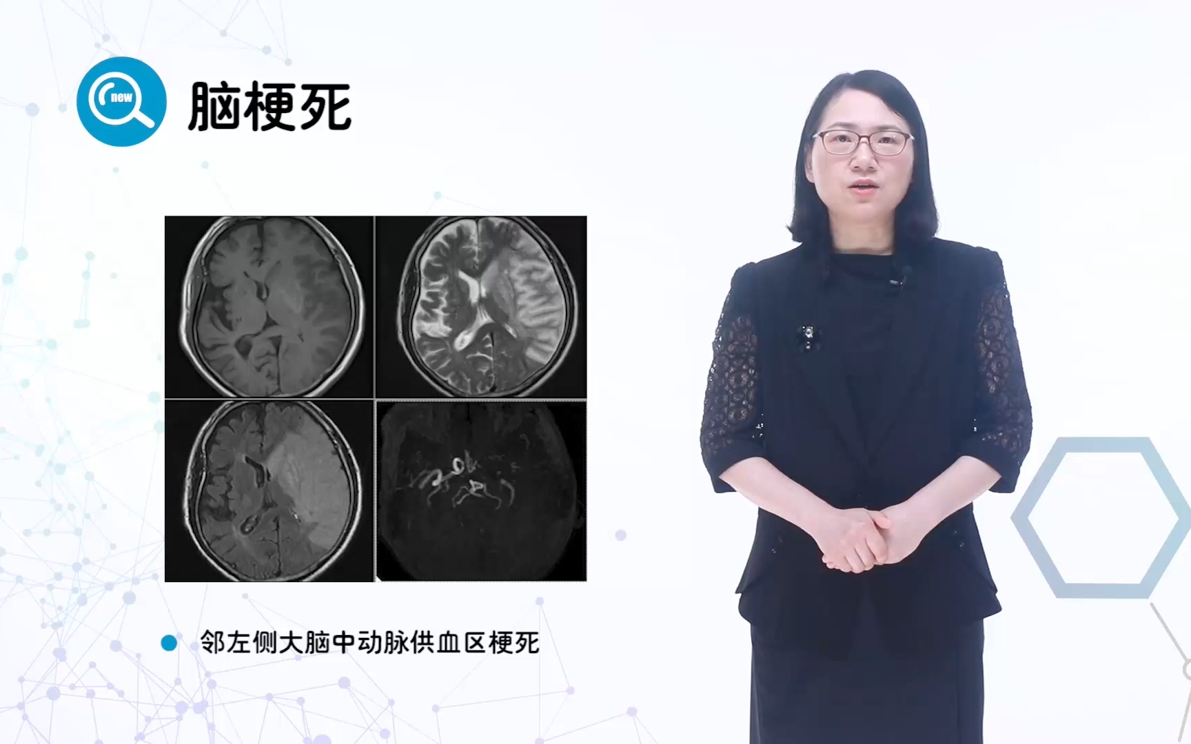 【影像诊断08】脑梗死