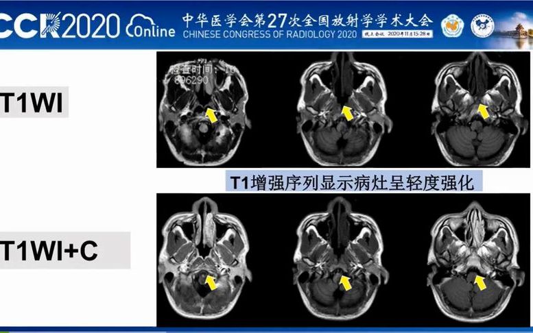 磁共振波谱(MRS)在脑卒中的应用价值-邱士军