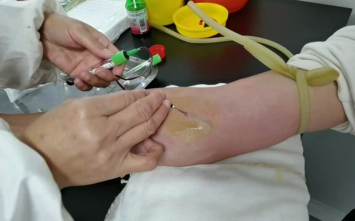 人类外周血淋巴细胞培养-采血2