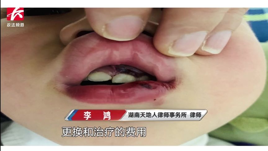 3岁男童坐园车时摔断门牙,幼儿园:是个意外