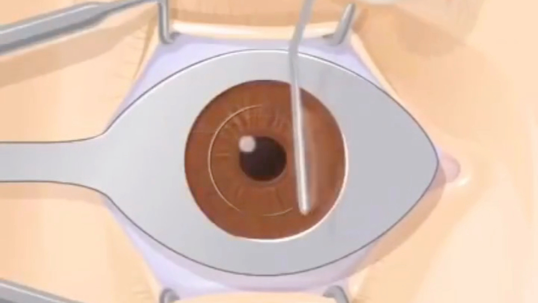 3D视频演示:眼睛激光手术