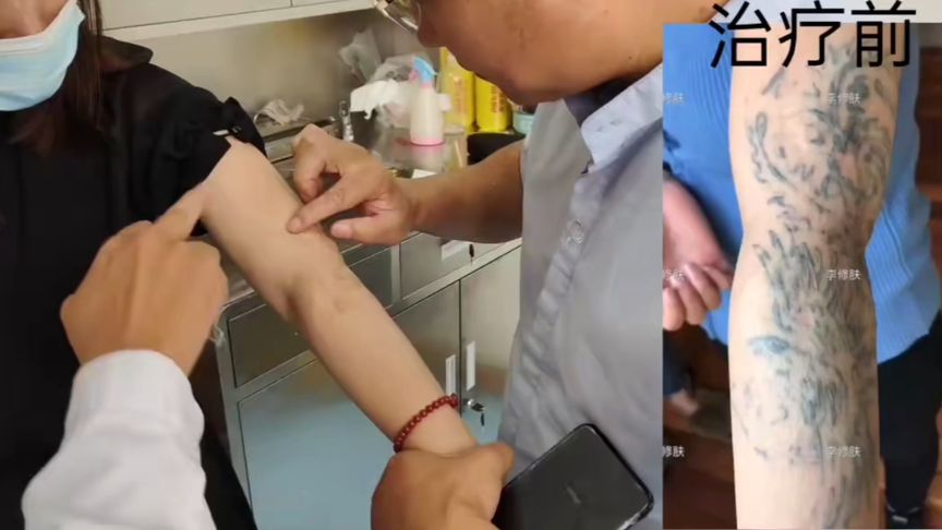 洗纹身留疤了怎么办,疤痕修复第三次过程展示!
